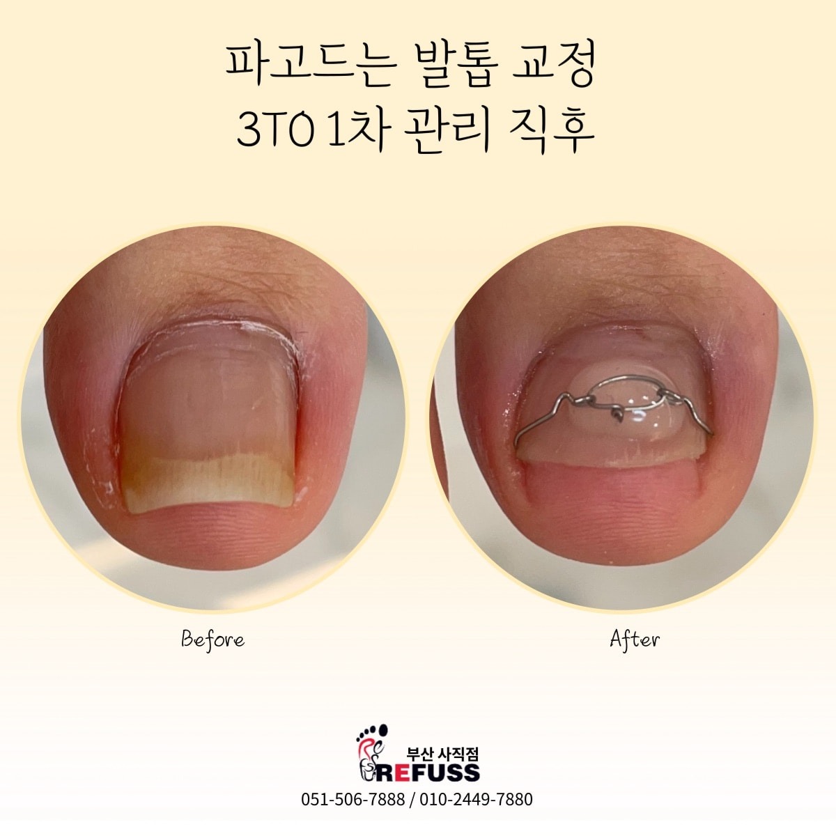 내성발톱 3TO 1차 관리 직후 | 부산광역시 동래구 사직동 | 미용 | 당근 비즈 소식