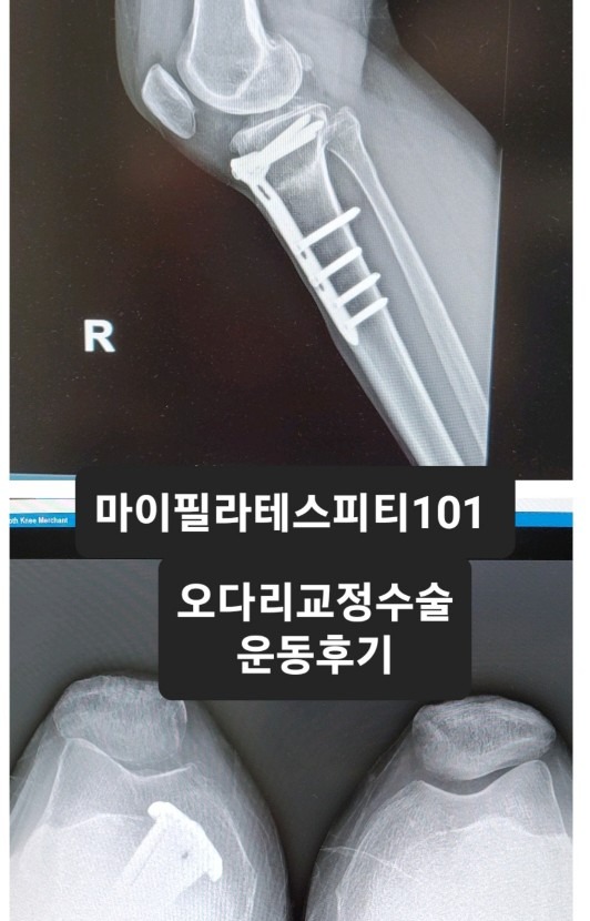 O다리 변형무릎통증으로 무릎절골술 한 회원님 운동후기 서울특별시 강남구 삼성동 비즈프로필