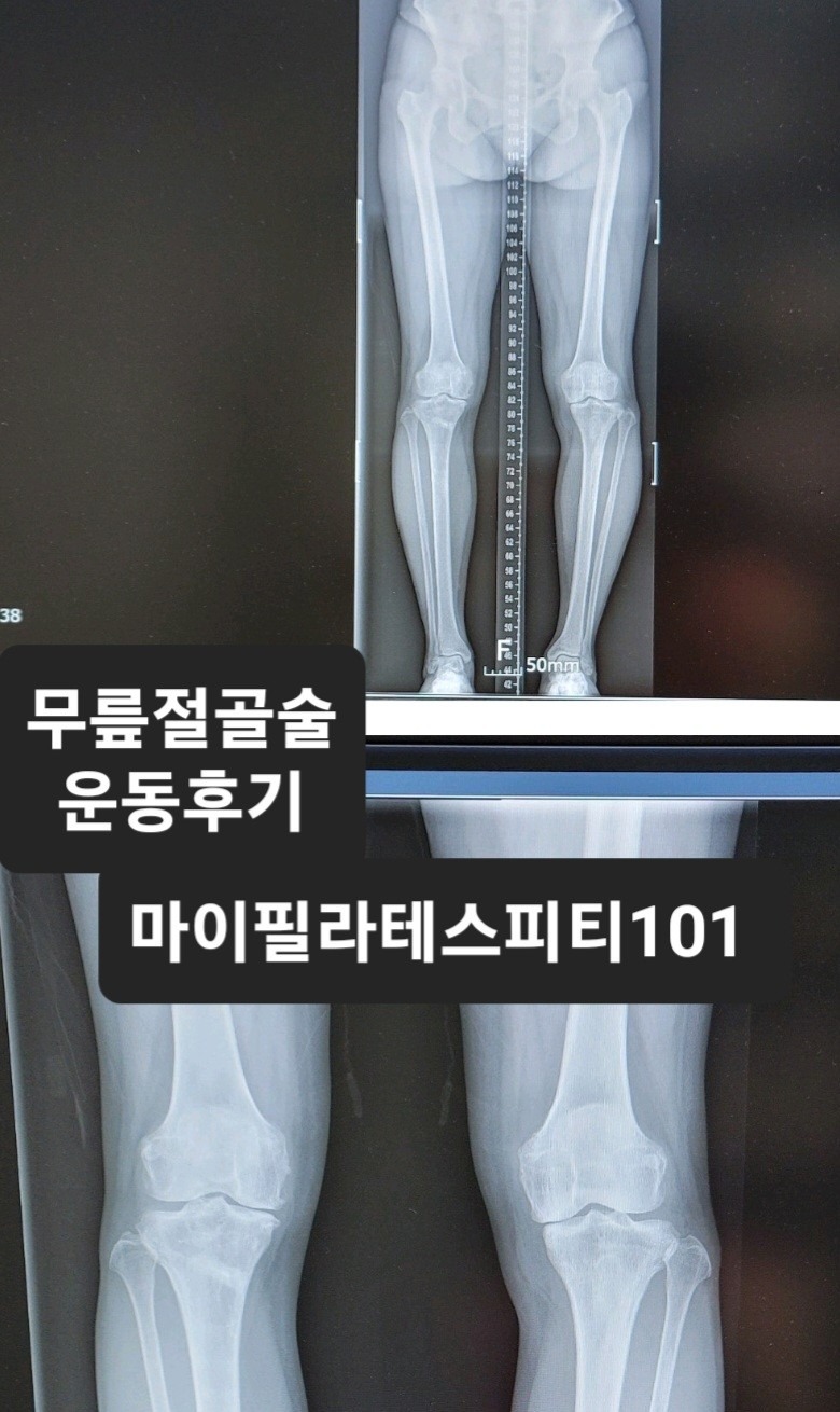 O다리 변형무릎통증으로 무릎절골술 한 회원님 운동후기 서울특별시 강남구 삼성동 비즈프로필