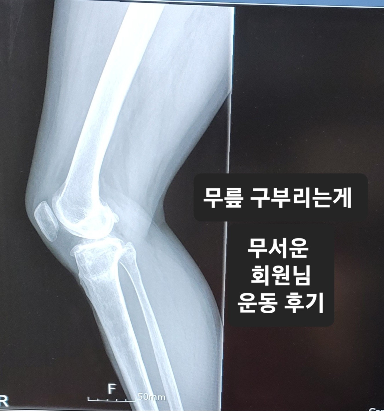 O다리 변형무릎통증으로 무릎절골술 한 회원님 운동후기 서울특별시 강남구 삼성동 비즈프로필