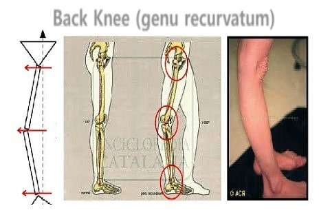 [원신흥동필라테스숲] 16.무너진 하지정렬의 원인,Back Knee (백니) - 대전광역시 유성구 원신흥동 | 비즈프로필