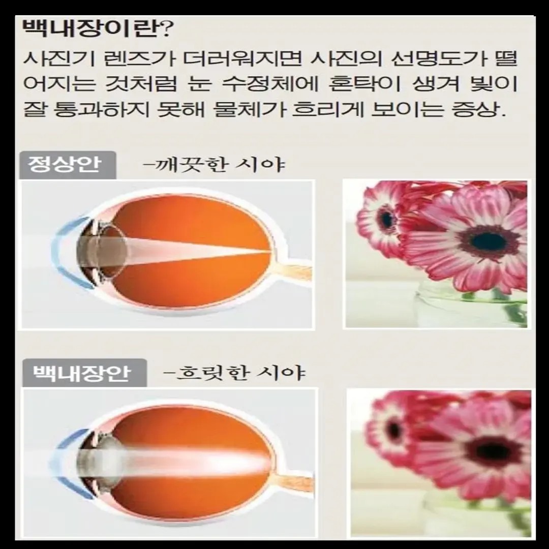 백내장이란 백내장 종류 백내장수술후 보호안경은 으뜸플러스안경 수원정자점 경기도 수원시 장안구 정자동 비즈프로필